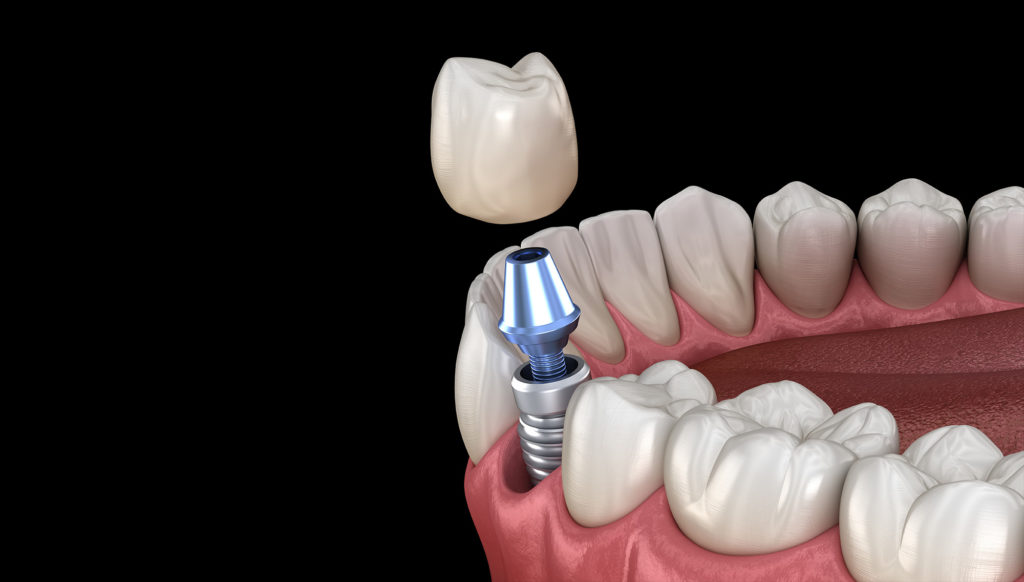 Implant Videos by Dentist Whitby | Margolian Dentistry
